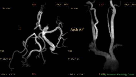 Dr Balaji Anvekar Frcr Insular Ribbon Sign In Acute Ischemia Dr Balaji Anvekar Frcr Insular Ribbon Sign In Acute Ischemia