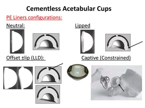 Cementless Acetabular Cups Pptx Bone And Joint Conditions Diseases And Conditions