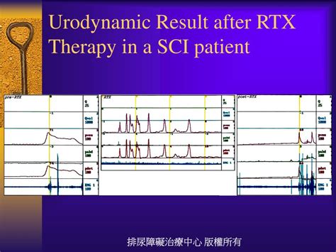 Ppt Recent Advances In Management Of The Neurogenic Voiding Dysfunction Powerpoint