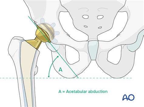 Total Hip Arthroplasty For Femoral Neck And Head Fractures With Hip