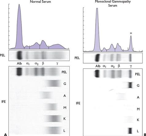 Multiple Myeloma Oncohema Key