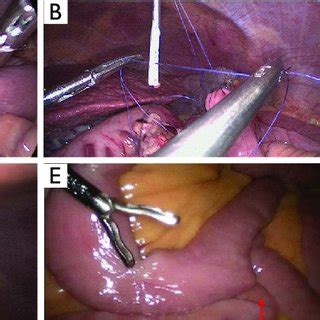 Condition Of Jejunostomy Tube After 4 Months From Operation The Arrow Download Scientific