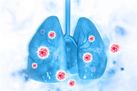 What Is Lobar Pneumonia Aapc Knowledge Center