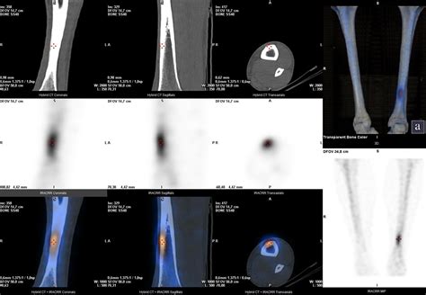 Scintigraphie Osseuse Normandim