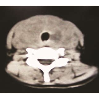 Axial Computed Tomography Showing Diffuse Infiltrate With No Precise Download Scientific