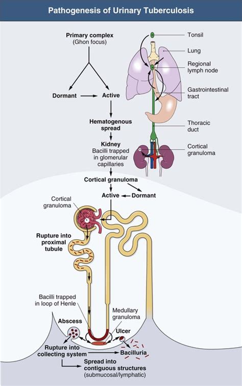 Tuberculosis Of The Urinary Tract Abdominal Key