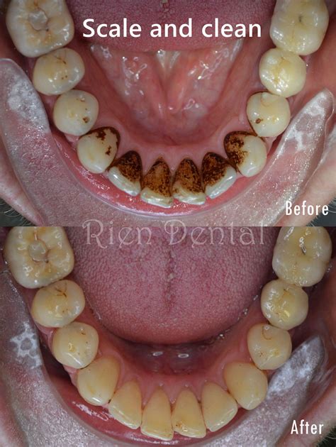 Causes Of Excessive Plaque On Teeth At Iva Blackburn Blog