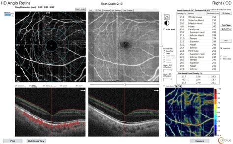 OCT A Of The SCP Of Patient Number 4 In Group II After Injection Of Download Scientific Diagram