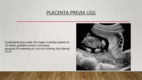 Placenta Types And Grading Pptx