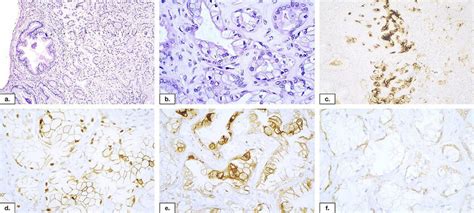 Intrahepatic Large Duct Cholangiocarcinoma The Lesion Has A Complex Download Scientific Intrahepatic Large Duct Cholangiocarcinoma The Lesion Has A Complex Download Scientific