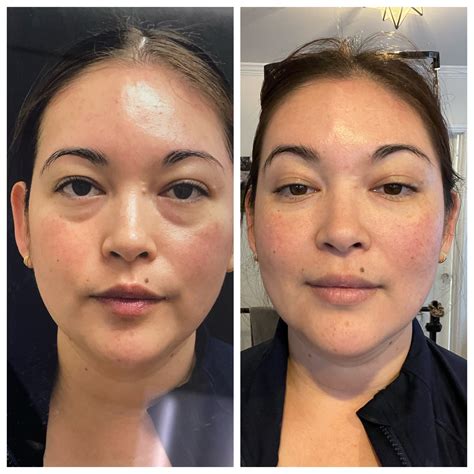 First Experience Injection Treatments Sonderbeaut
