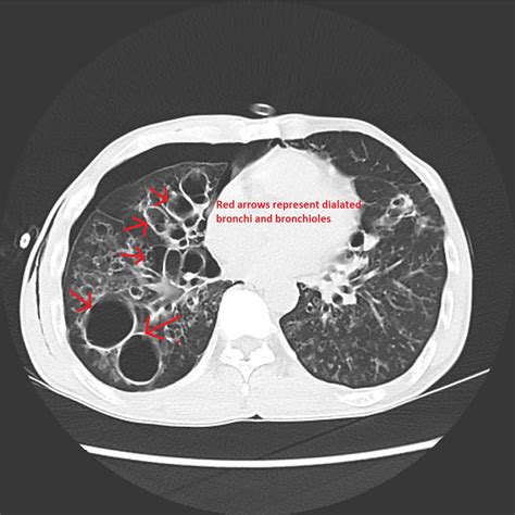 Bronchiectasis CT Wikidoc