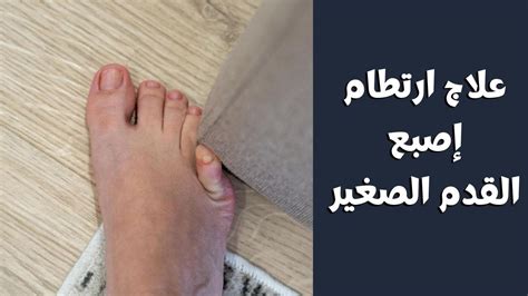 كيف نتعامل مع اصابة اصبع القدم الصغير عند الارتطام بالباب أو الكرسي