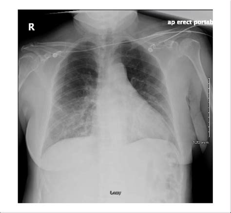 Chest X Ray Showing Bilateral Interstitial Infiltrates Download Scientific Diagram