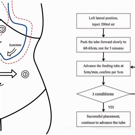 Placement Checklist For Post Pyloric Nutritional Tube Placement