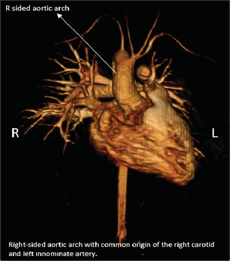Figure Shows The Right Aortic Arch With A Common Origin Of The Right