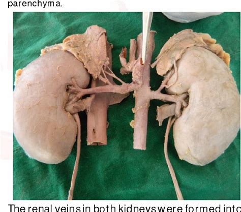 Figure 3 From Unilateral Double Pelvis Bifid Ureter Associated With Multiple Variations Of Renal
