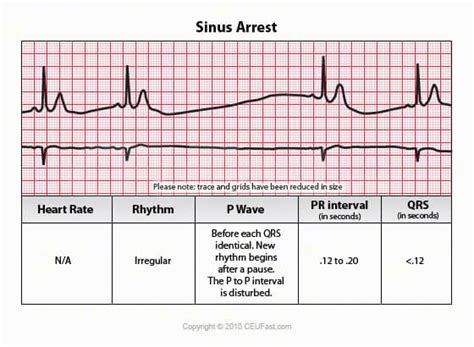 Ekg Ecg Interpretation