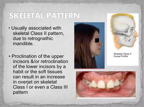 Class 2 Malocclusion Pptx