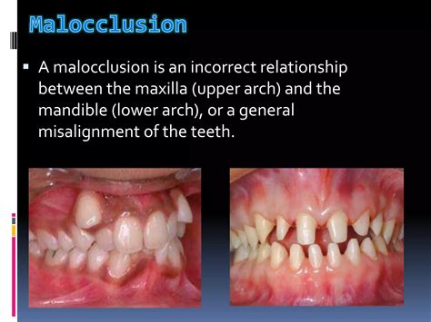 Specific Causes Of Malocclusion Pptx
