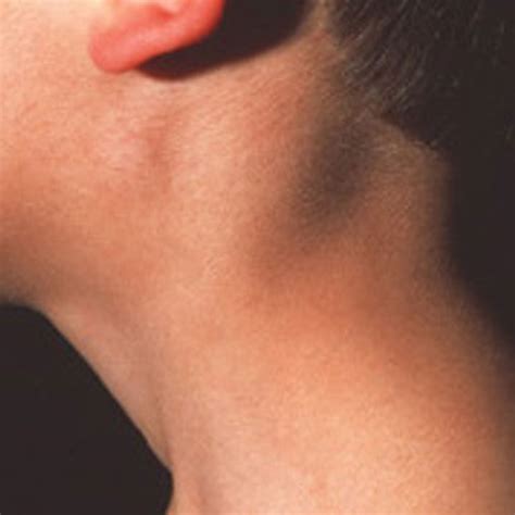 Lump Back Of Neck Lymphoma