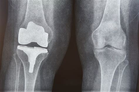Robotic Assisted Joint Replacement Mr Koushik Ghosh