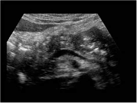 Abdomen And Retroperitoneum 1 3 Pancreas Case 1 3 7 Pancreas Calcifications Ultrasound Cases
