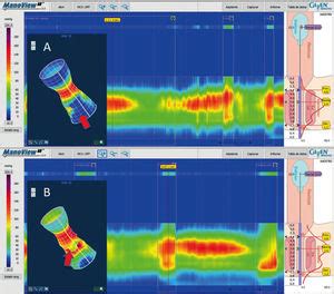 Manometría Anorrectal De Alta Resolución Y De Alta Definición Fmc