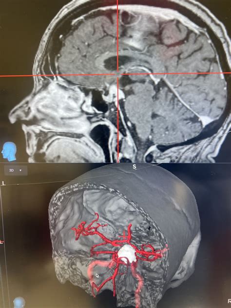 Neurosurgery Neuronavigation 3dmodeling Circleofwillis Patientsafety… Alex Munoz