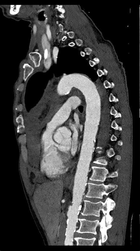 Central Venous Catheter Tip Extravasation Radiopaedia 82828 97113 F