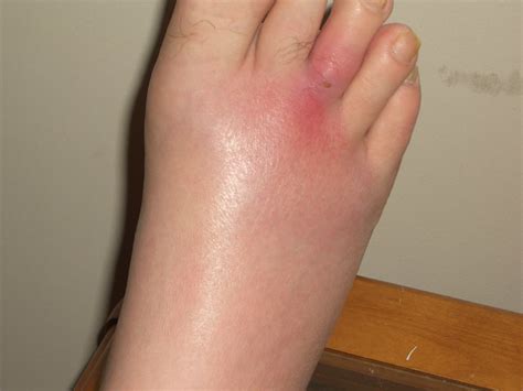 Mrsa Infection Flickr