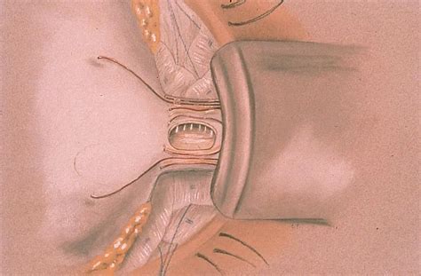 Optic Nerve Sheath Decompression American Academy Of Ophthalmology