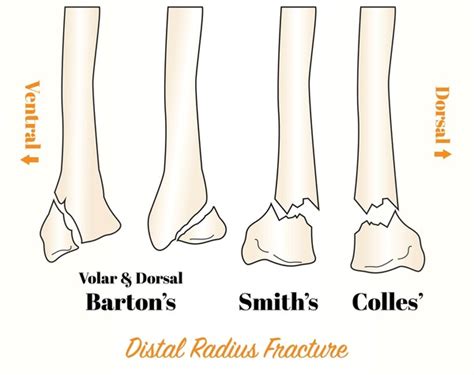 Colles Fracture Smith Fracture Over 8 Royalty Free Licensable Stock
