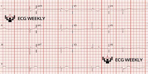 Key Points To Note About Complete Heart Block Ecg Weekly