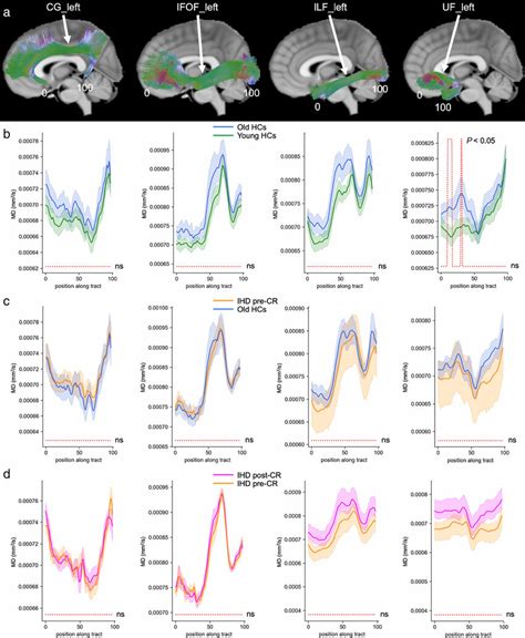 A Diffusion Tractography Visualization Of Left CG IFOF ILF And UF Download Scientific