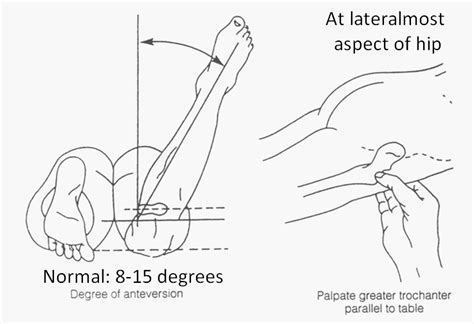 Not All Hips Are Created The Same Hip Anteversion And Retroversion