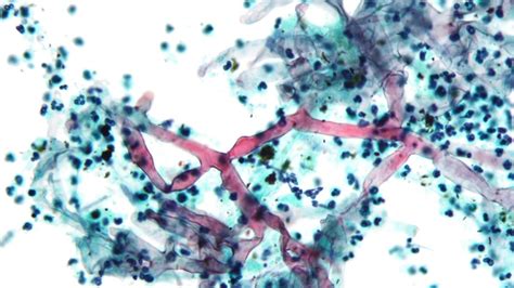 50 Mn Indians At The Risk Of Being Affected By Serious Fungal Diseases