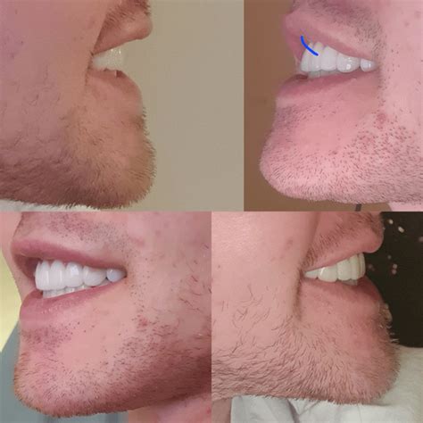 Space Between My Teeths And Lips R Jawsurgery