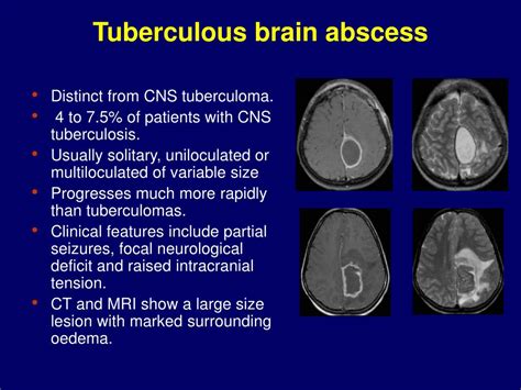 Ppt Cns Tuberculosis Powerpoint Presentation Free Download Id6336519