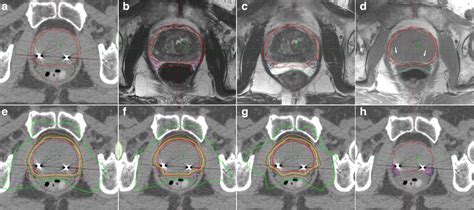 A CT Axial Slice Showing CTV PTV Hydrogel And Rectum Contours With Download Scientific