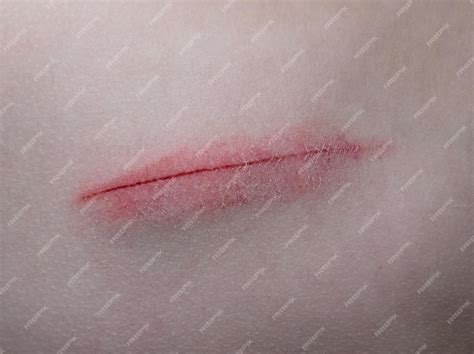 피부 찰과상 또는 복부 긁힘 의료 찰과상 부상 또는 상처 프리미엄 사진