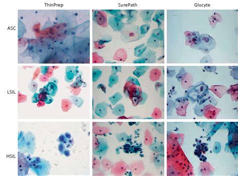 Figure 1 From Performance Of The Cellsolutions Glucyte Liquid Based Cytology In Comparison With