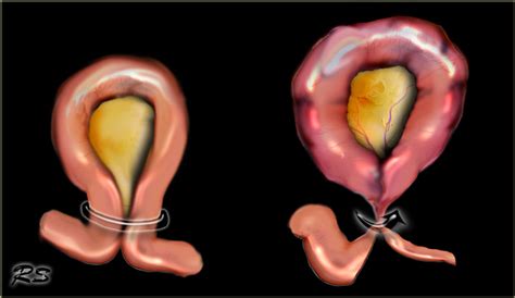 The Radiology Assistant Closed Loop Obstruction In Small Bowel