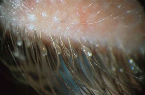 Pediculosis And Palpebral Phthiriasis Lice On The Eyelids Dr Reichmann