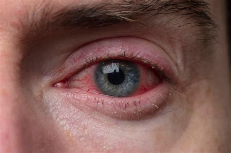 Gonococcal Conjunctivitis Gonorrhea In The Eye