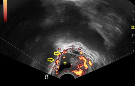 Hematoma In Retzius Space Following Us Guided Prostate Biopsy