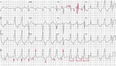 Ecg Case 184 Accelerated Idioventricular Rhythm Manual Of Medicine