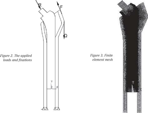 Figure 3 From A New Design Of Hip Prosthesis Coating Using Functionally Graded Material