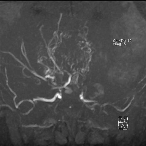 Cerebral Mri Angiogram At Age Of 16 Months After First Bypass Surgery