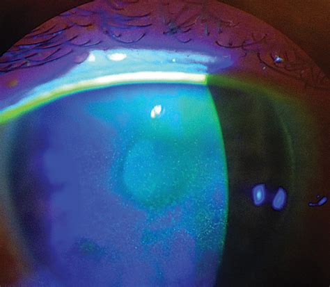 Superficial Punctate Keratitis Spk